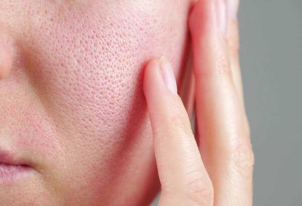 Do Fleas Lay Eggs Under the Skin? - PatchPuppy.com